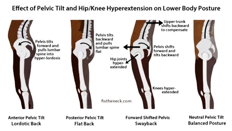 Posterior Pelvic Tilt: Bad posture, big problems, easy fixes - Oregon ...
